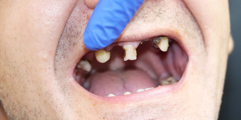 Meth Mouth: The Effects of Meth Addiction | NATC