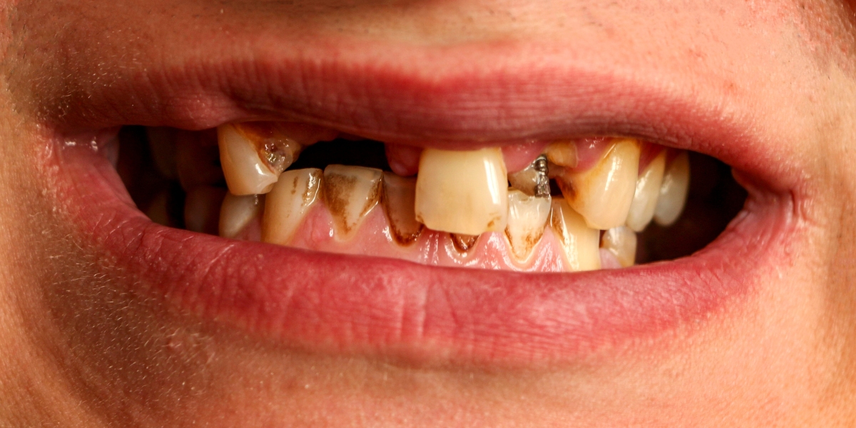 Meth Mouth: The Effects of Meth Addiction | NATC